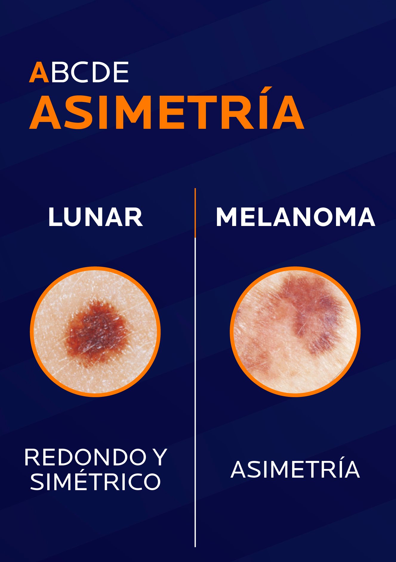 Salva tu piel: protegé tu piel y lunares del sol - La Roche Posay